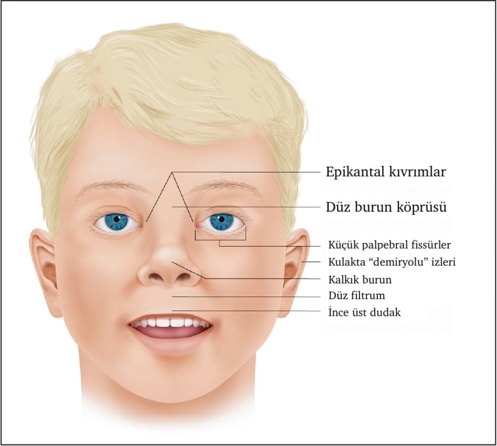 Fetal Alkol Sendromu Nedir? Hamilelikte Alkol Tüketiminin Zararları ...