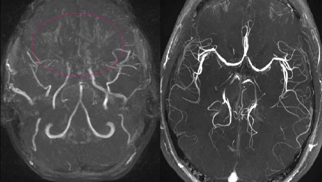 Moyamoya Hastalığı Nedir? Belirtileri ve Tedavi Seçenekleri Nelerdir ...