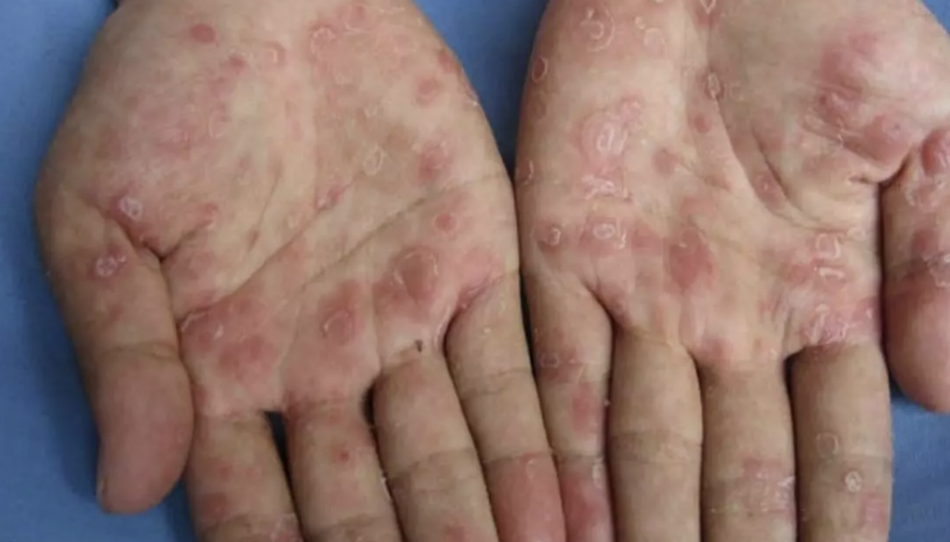 Sifiliz hastalığı ve belirtileri - Evrim Ağacı