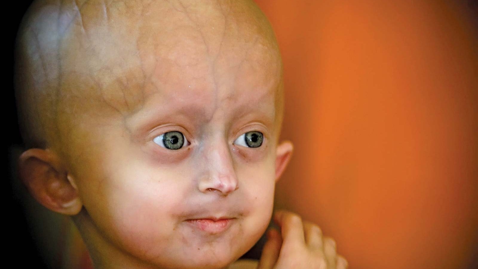 Erken Yaşlanma Hastalığı (Progeria) - Evrim Ağacı