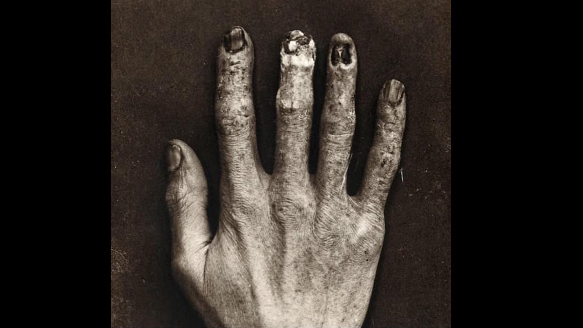 Clarence Dally: Thomas Edison'ın Radyasyon Nedeniyle Hayatını Kaybeden ...