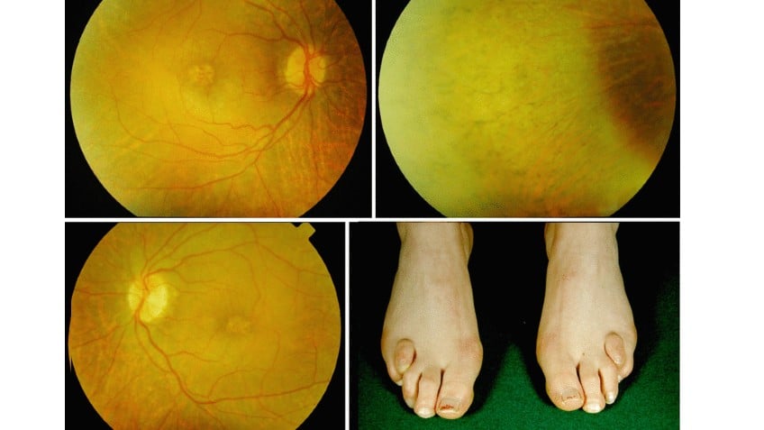 Refsum Hastalığı Nedir? Nasıl Tedavi Edilir? - Evrim Ağacı