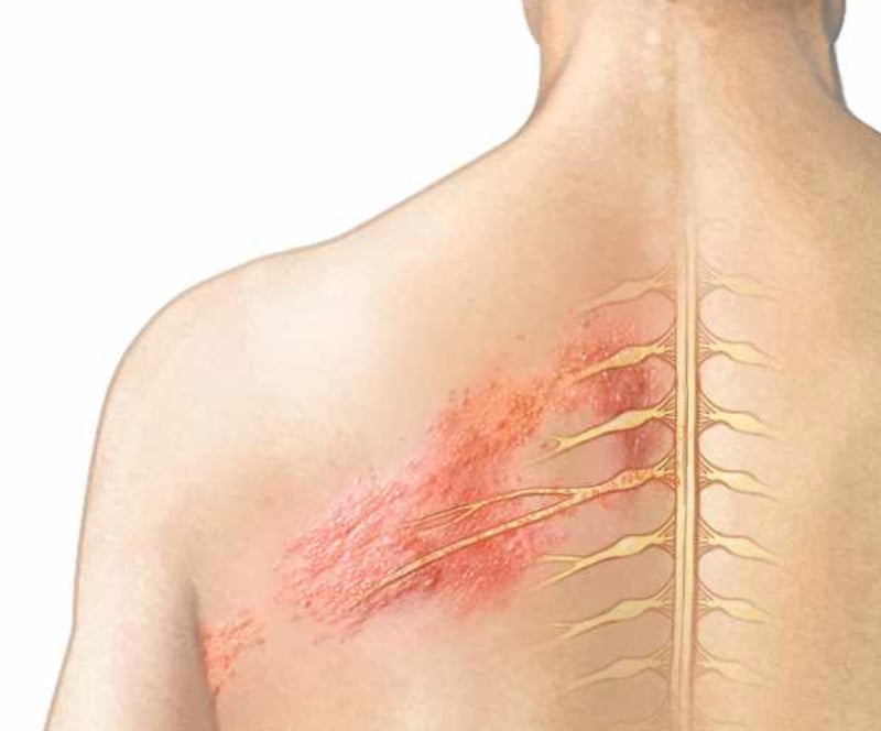 Zona (Herpes Zoster) - Evrim Ağacı