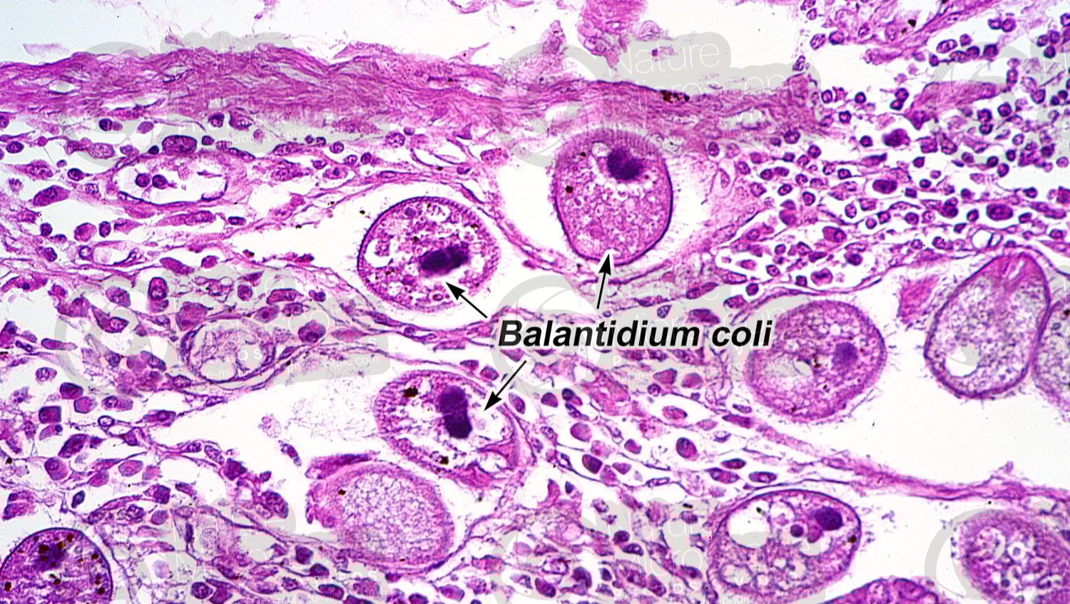 Balantidiasis Nedir? Nadiren Semptom Veren "Balantidium coli" Paraziti ...